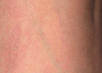 Capillary Reduction | Skin Clique