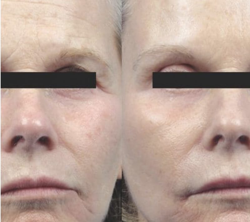 eTwo™ Sublative & Fractional RF | Skin Clique | Skin Treatments