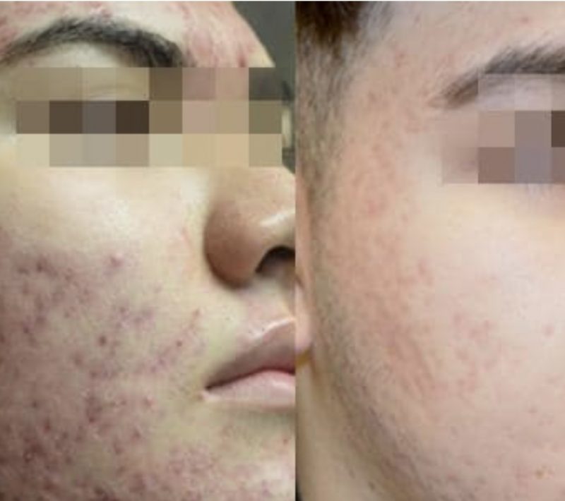 eTwo™ Sublative & Fractional RF | Skin Clique | Skin Treatments